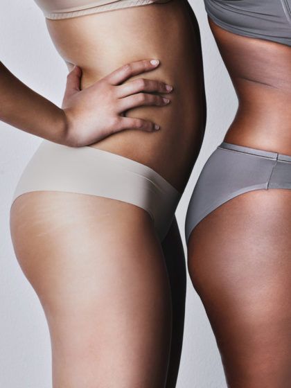 Wie entstehen eigentlich Dehnungsstreifen und gibt es Tipps, die dagegen helfen?